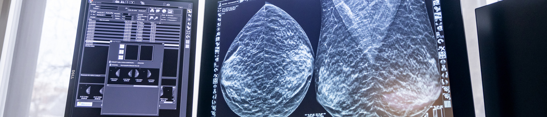 Microbiopsie mammaire - Radiologie MIM
